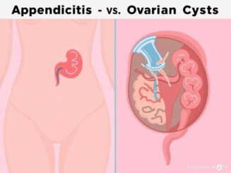 Appendicitis vs. Ovarian Cysts: Key Differences in Women’s Health