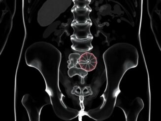 Psoas Sign in Appendicitis: Key Indicator for Diagnosis and Treatment