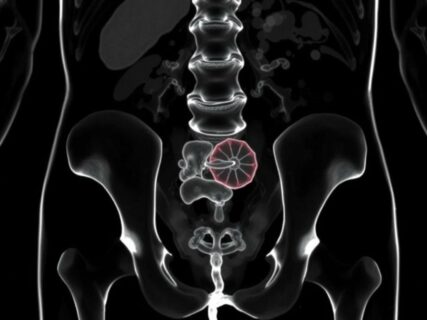 Psoas Sign in Appendicitis: Key Indicator for Diagnosis and Treatment