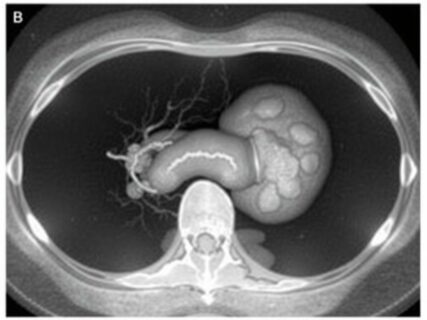 Rovsing’s Sign: A Key Diagnostic Indicator for Appendicitis