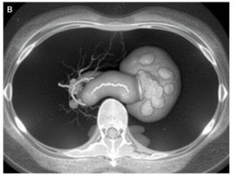 Rovsing’s Sign: A Key Diagnostic Indicator for Appendicitis