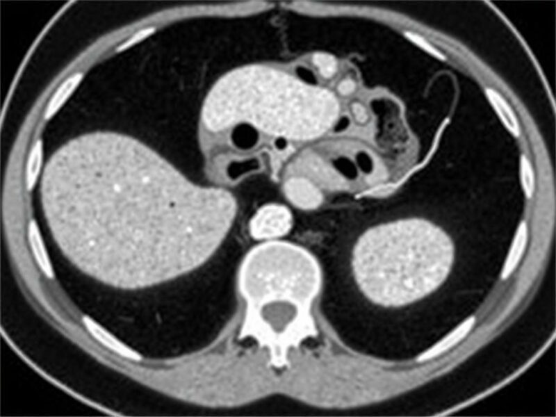Rincón de Radiología: reconocer apendicitis en TAC
